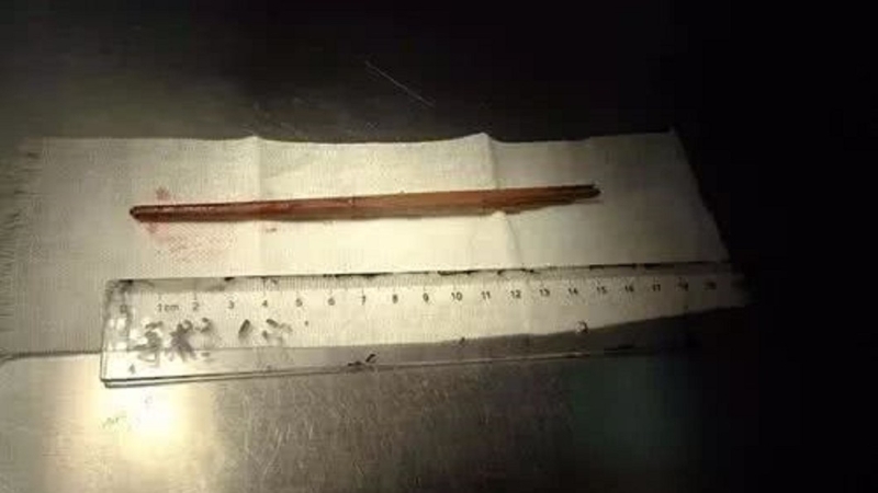 Toddler In China Falls With Chopstick In Mouth, It Pierces Her Brain ...