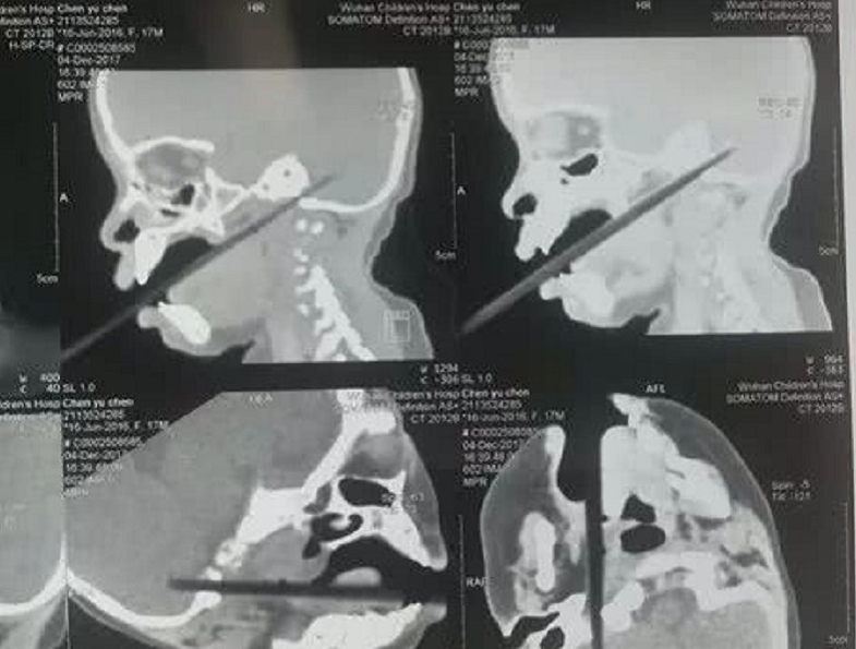 Toddler In China Falls With Chopstick In Mouth, It Pierces Her Brain ...