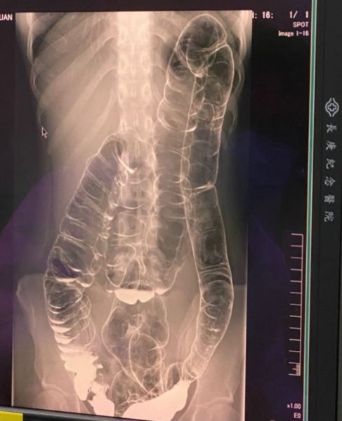 Taiwan Woman With Bad Constipation Posts X-Ray Scan, Netizens Shocked ...