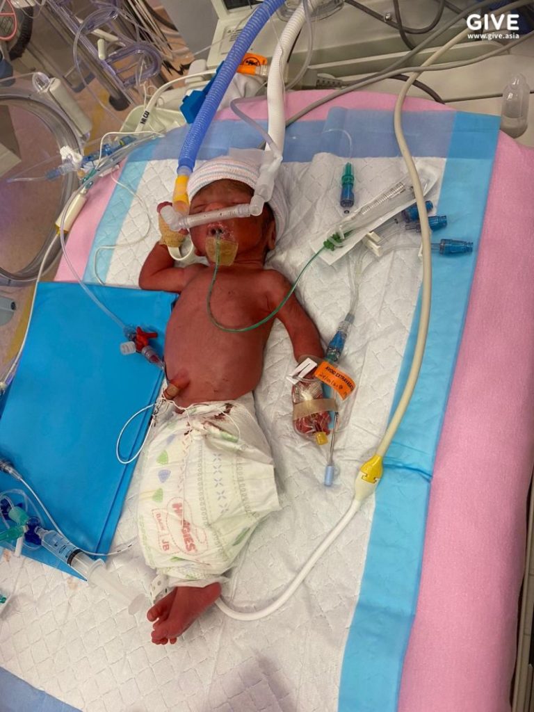 Couple In S'pore Gives Birth To 28-Week-Old Premature Baby, Needs $220K ...