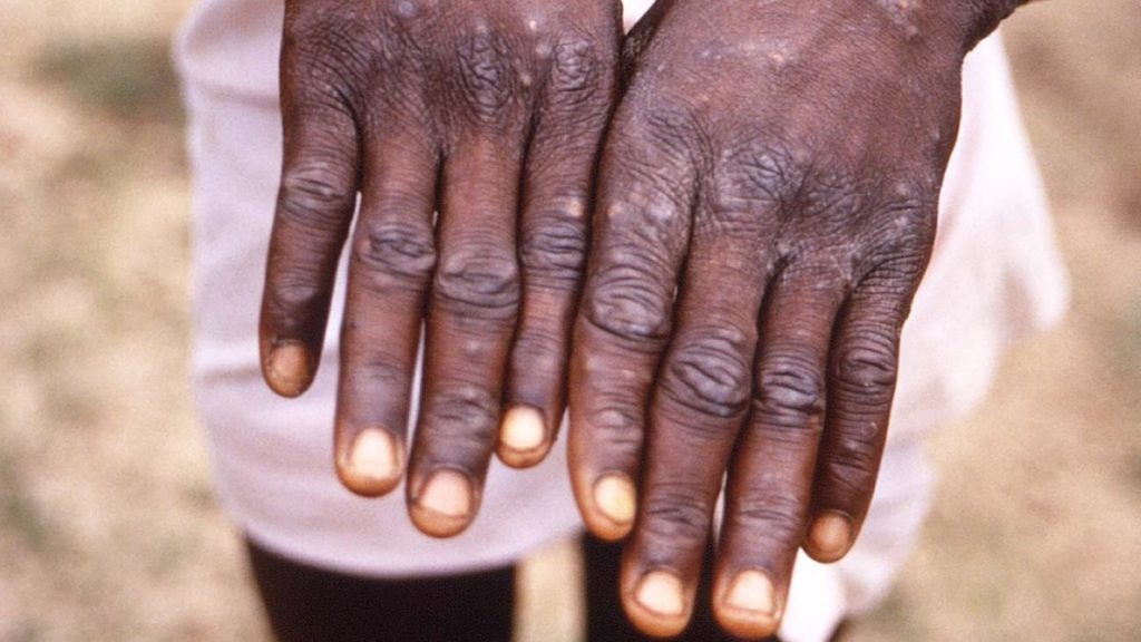 Monkeypox May Reach S'pore Sometime, Protocols & Measures Ready If ...