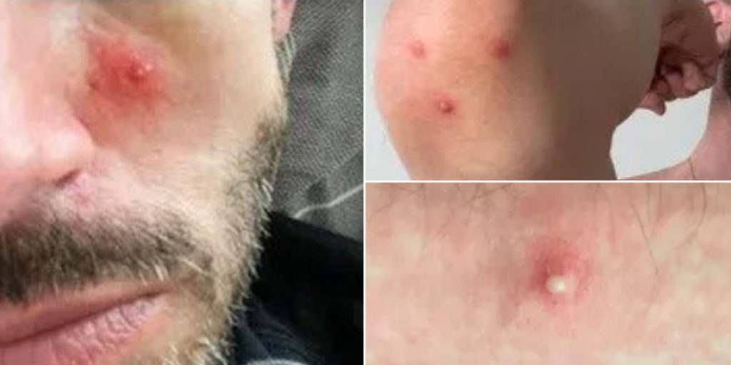 Swedish Man Describes Experience With Monkeypox, Had Over 50 Lesions ...