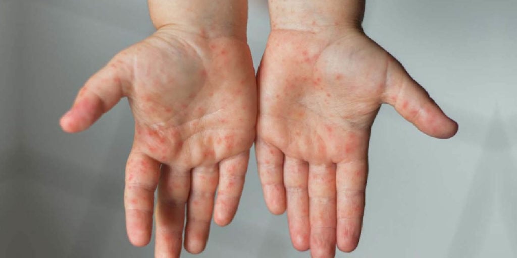 S'pore Confirms 11th Monkeypox Infection, 32-Year-Old S'porean Warded ...