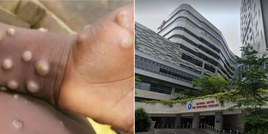 S’pore Confirms 3rd Imported Monkeypox Case, Patient Recently Returned ...