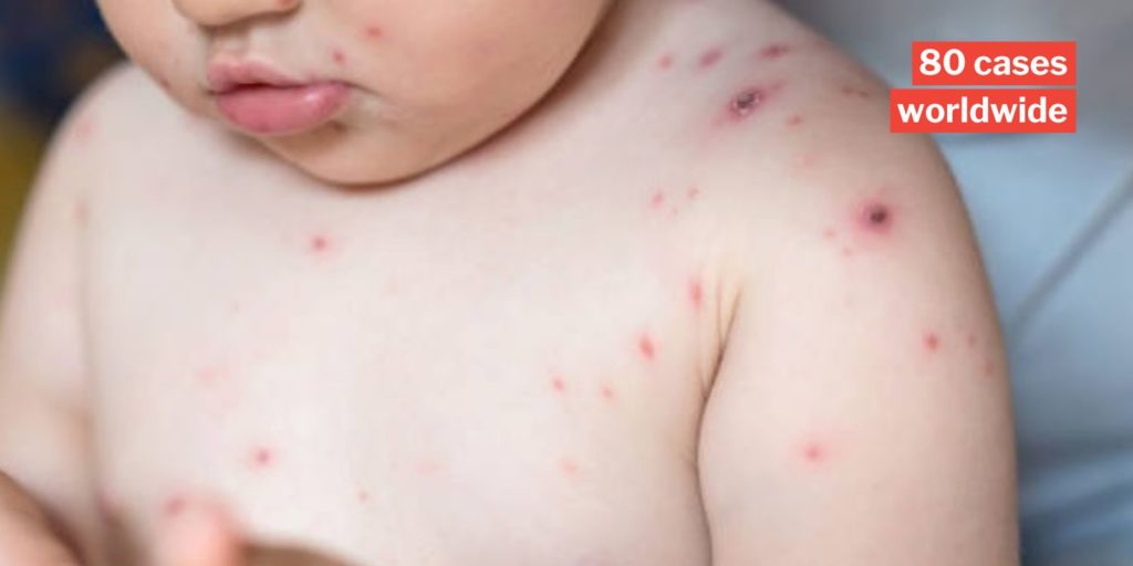 Monkeypox Reportedly Infecting Kids Worldwide, WHO Monitoring Potential ...