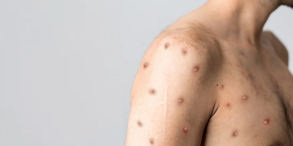 S'pore Reports 16th Monkeypox Infection On 25 Aug, 3 Weeks Since ...