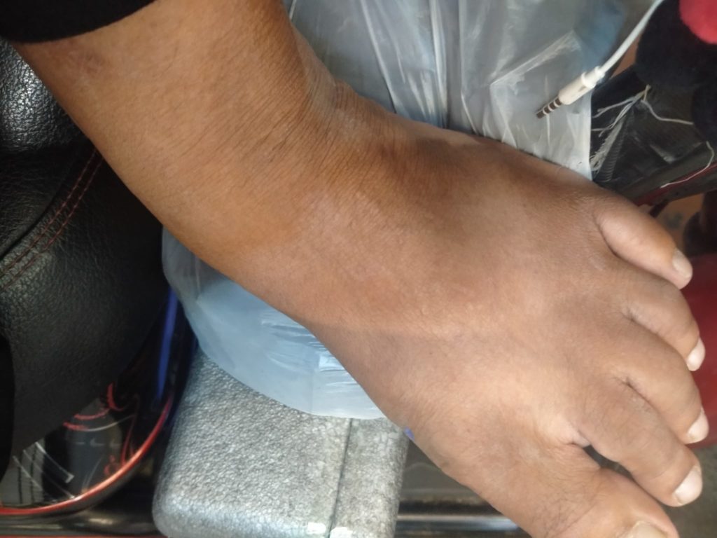 One-Legged Delivery Rider Falls While Climbing Stairs, Claims Customer ...