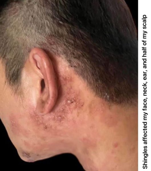 Former Mediacorp Actor Nick Shen Battles 'Agonising' Shingles For 3 ...
