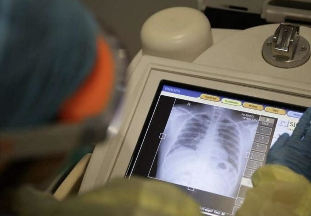 2 Bukit Merah Blocks & Market To Be Screened For Tuberculosis After ...