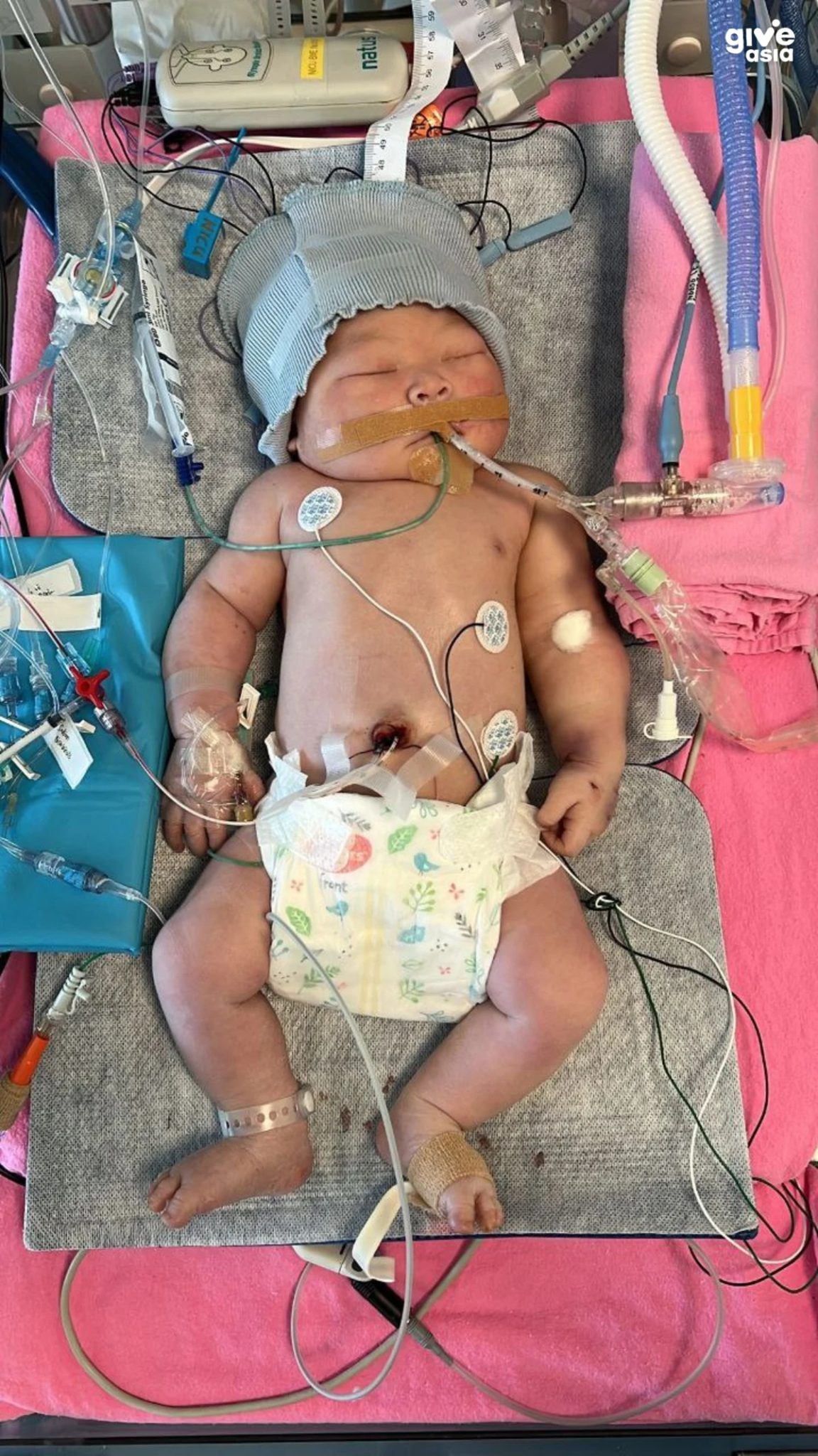 S'pore baby born with cerebral palsy sleeps with ventilator nightly ...