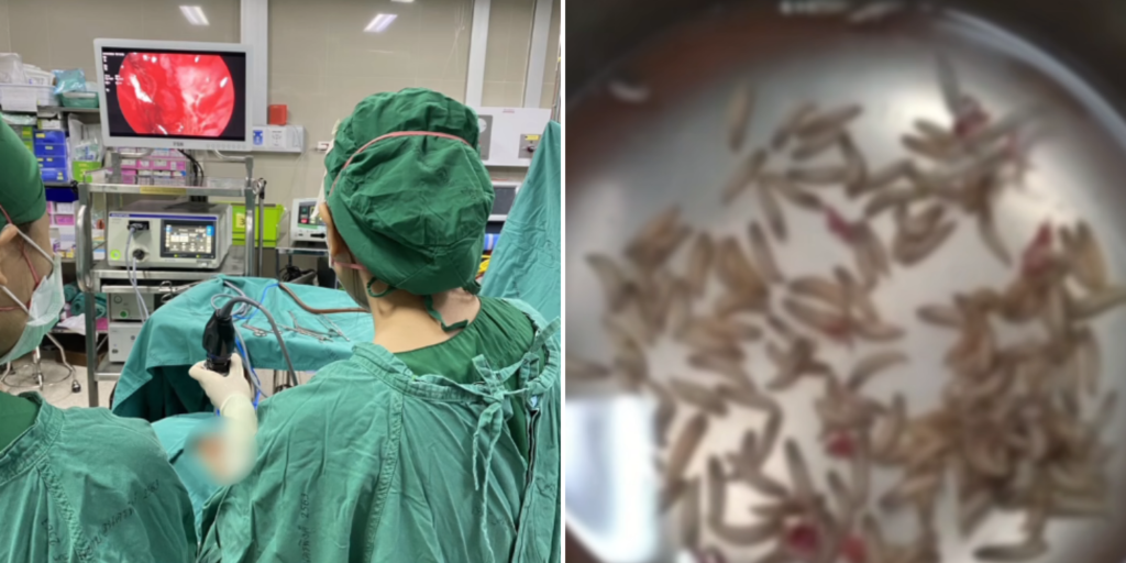 Woman gets 100 maggots removed from nasal cavity in Thailand