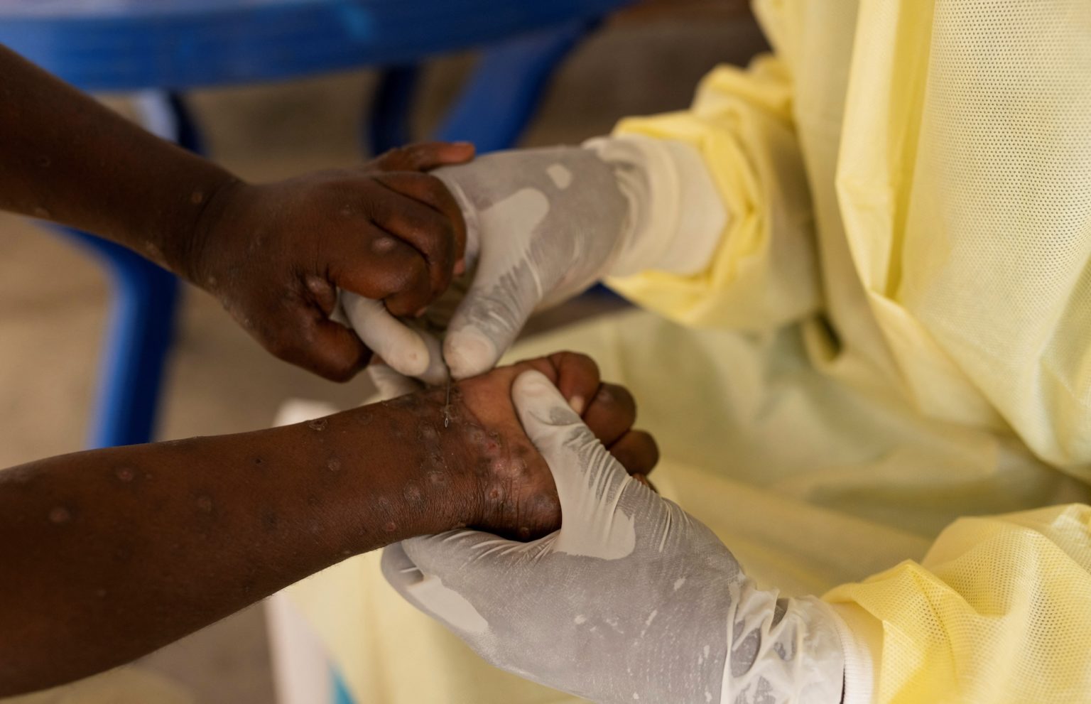 First case of mpox detected in Thailand, 66-year-old patient recently ...