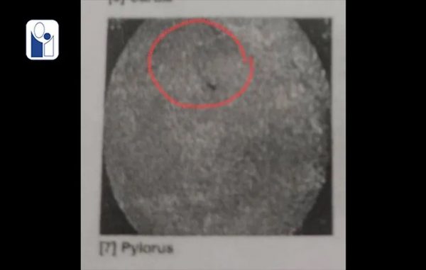 Woman in Thailand experiences pain for 18 years due to needle left in ...