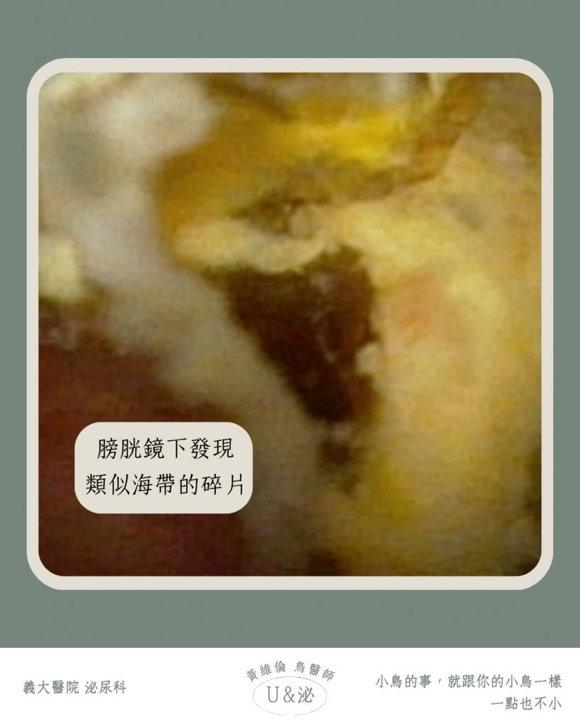 Man in Taiwan complains of blood in urine, discovers food bits inside ...
