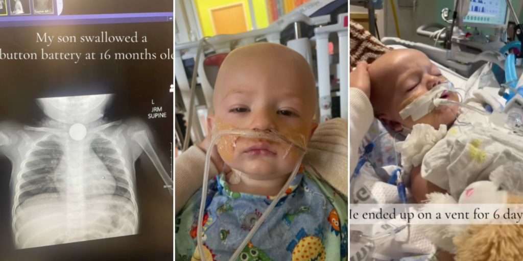 Toddler in US undergoes 29 operations after swallowing button battery