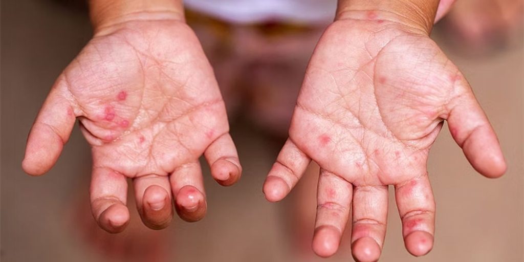 21,315 cases of HFMD reported in Thailand, authorities cite early ...