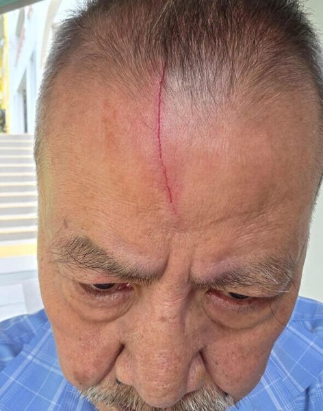 Aggressive crows attack residents in Tampines, leave 8cm wound on ...