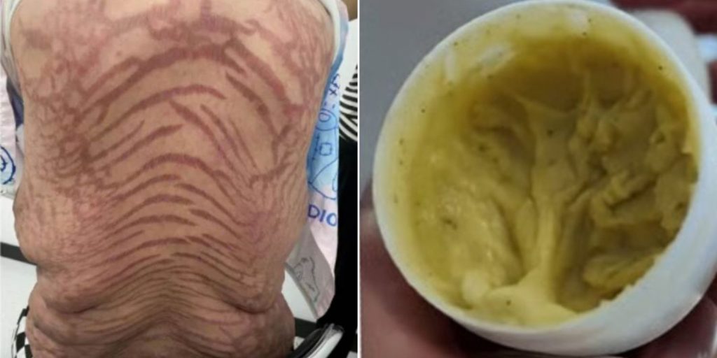 Woman in China develops snake-like patterns on back after using TCM ...
