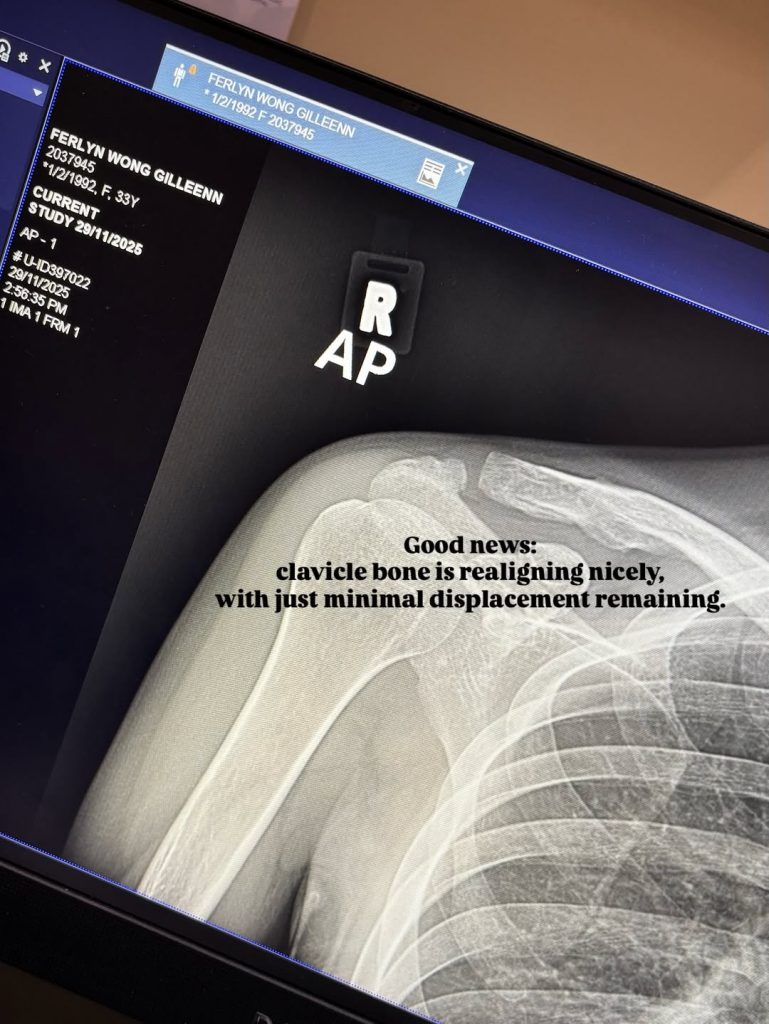 S'pore actress Ferlyn G fractures collarbone, continues filming for ...